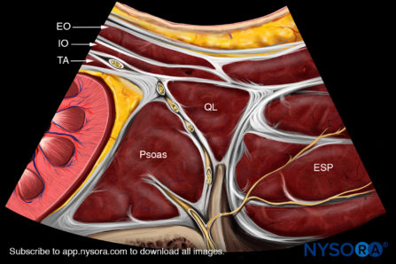 Quadratus Lumborum Ql3 Block Usg Guided Youtube