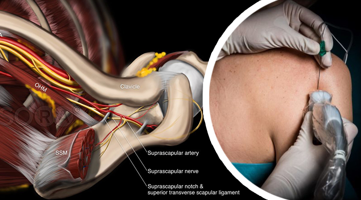 Shoulder Block Nysora E Learning System