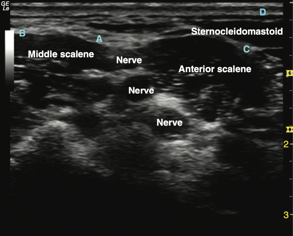 Ultrasound-Guided Cervical Plexus Block - NYSORA Learning System