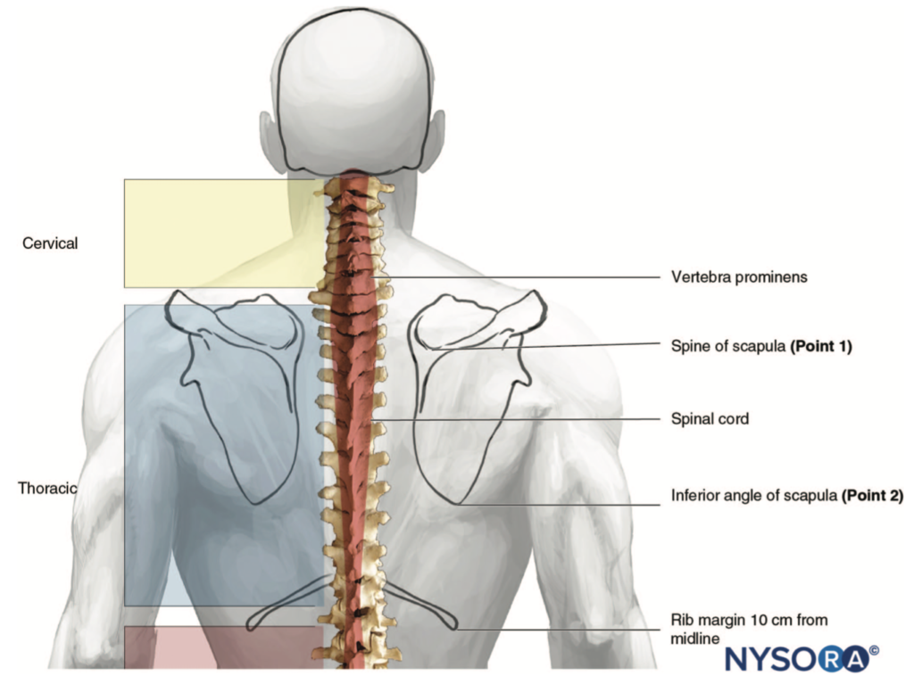Epidural Anesthesia and Analgesia - NYSORA Learning System