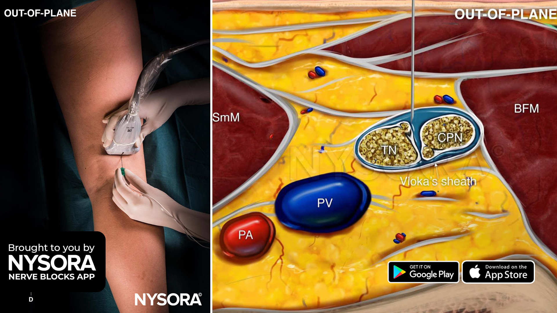 Femoral Nerve Block Nysora