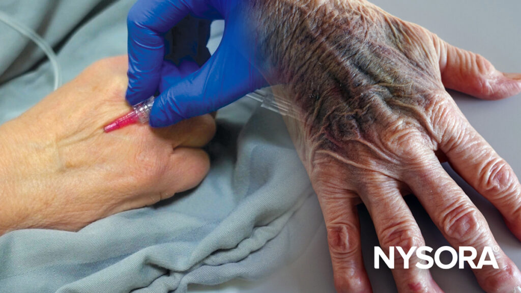 Mastering Difficult IV Access - NYSORA 360